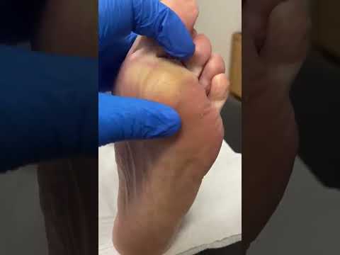 Satisfying Callus Removal in Australia: Foot Transformation by Podiatr ...